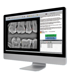 Logicon Caries Detector Software – The Smile Gallery